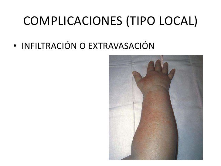 Cuidados de enfermería venoclisis