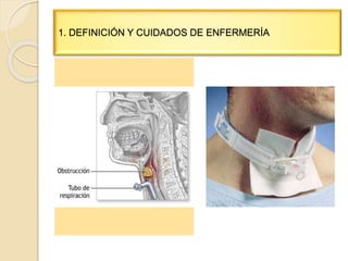 Cuidado De La Traqueotomía