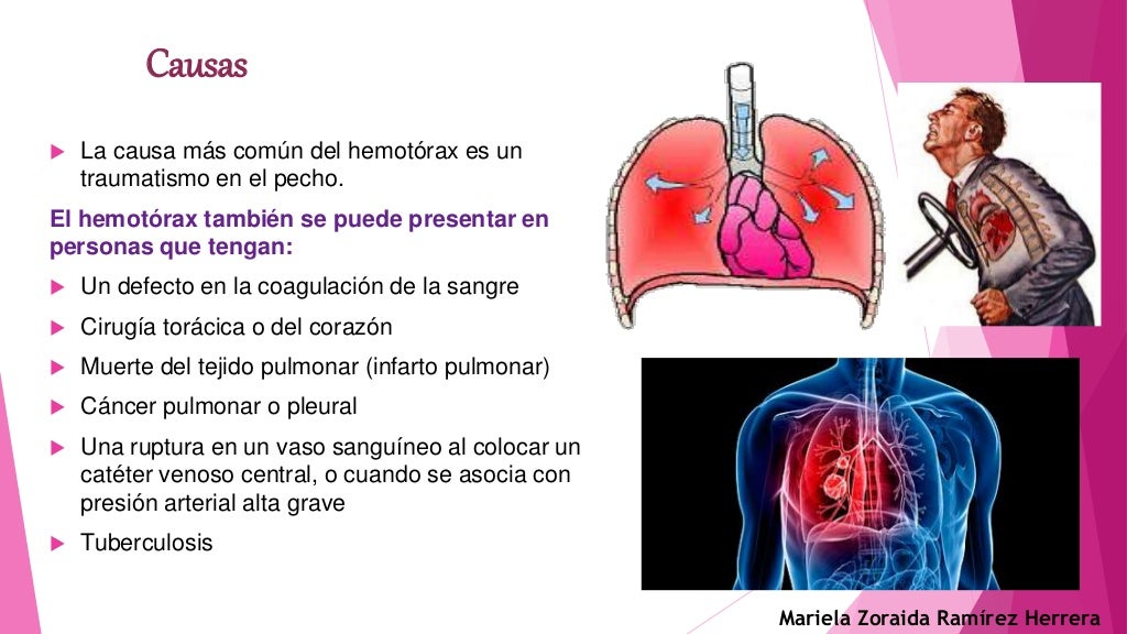 Cuidados de enfermeria en hemotorax neumotorax, piotorax,quilotorax