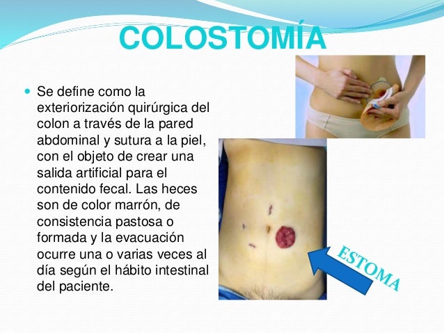 OSTOMIA Y TRAQUEOSTOMIA