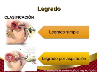 Culdocentesis y legrado | PPT