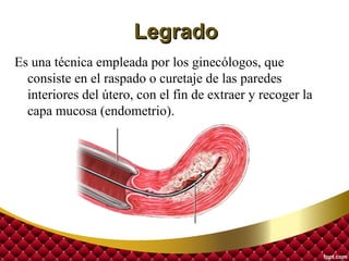 Culdocentesis y legrado | PPT