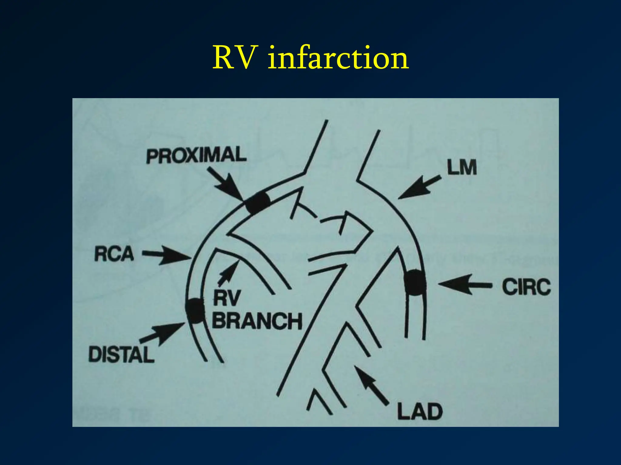 CULPRIT ARTERY LOCALISATION IN STEMI _ DR BIJILESH.ppsx