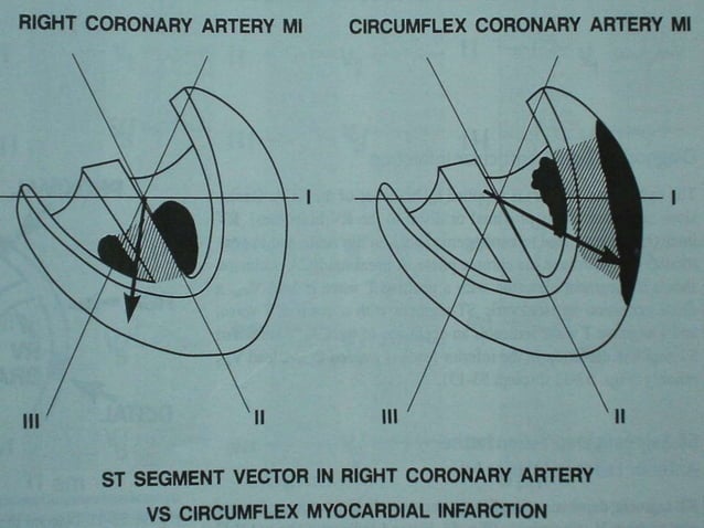 CULPRIT ARTERY LOCALISATION IN STEMI _ DR BIJILESH.ppsx | Heart and ...