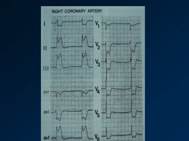 CULPRIT ARTERY LOCALISATION IN STEMI _ DR BIJILESH.ppsx | Heart and ...