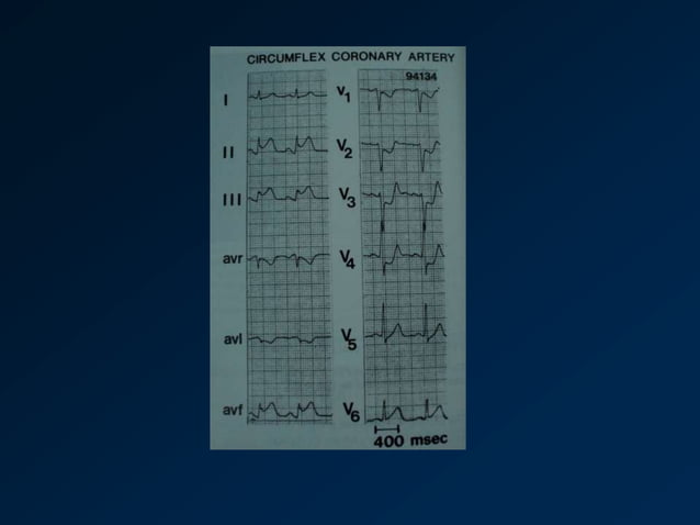 CULPRIT ARTERY LOCALISATION IN STEMI _ DR BIJILESH.ppsx | Heart and ...