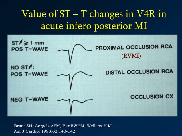 CULPRIT ARTERY LOCALISATION IN STEMI _ DR BIJILESH.ppsx | Heart and ...
