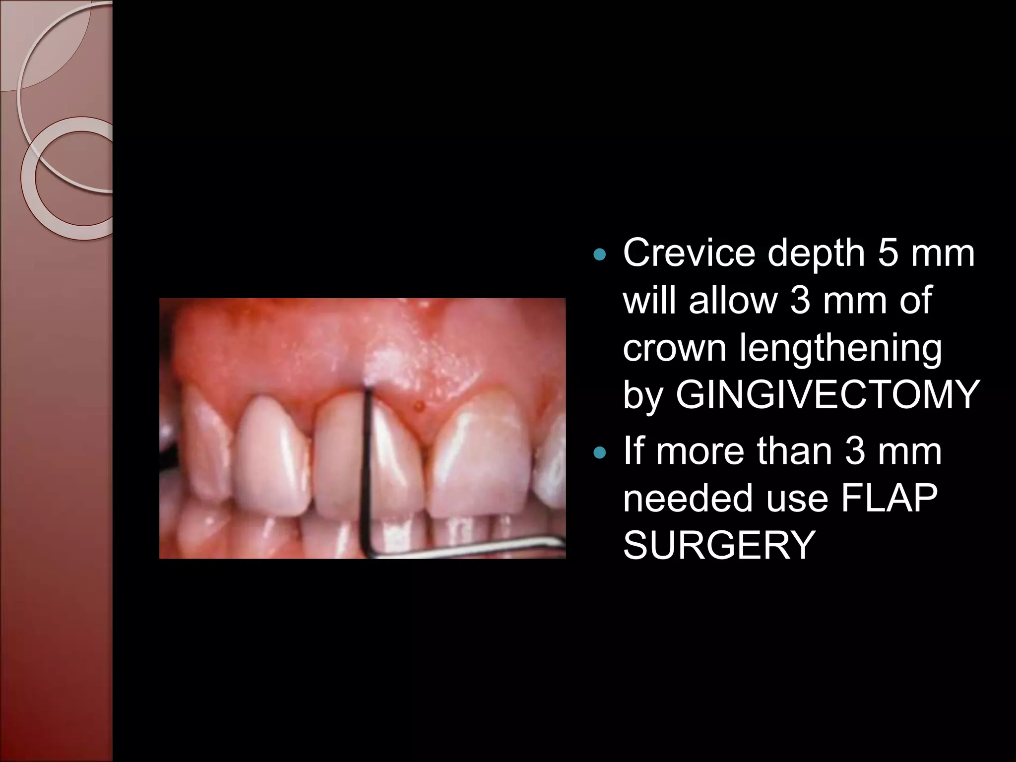 cupdf.com_surgical-crown-lengthening.ppt