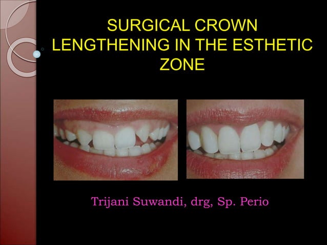 cupdf.com_surgical-crown-lengthening.ppt | Dental Health | Diseases and ...