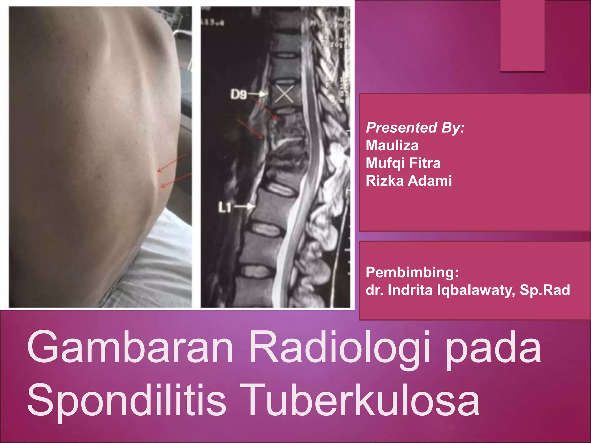 cupdf.com_slide-lapkas-spondilitis-tb.ppt