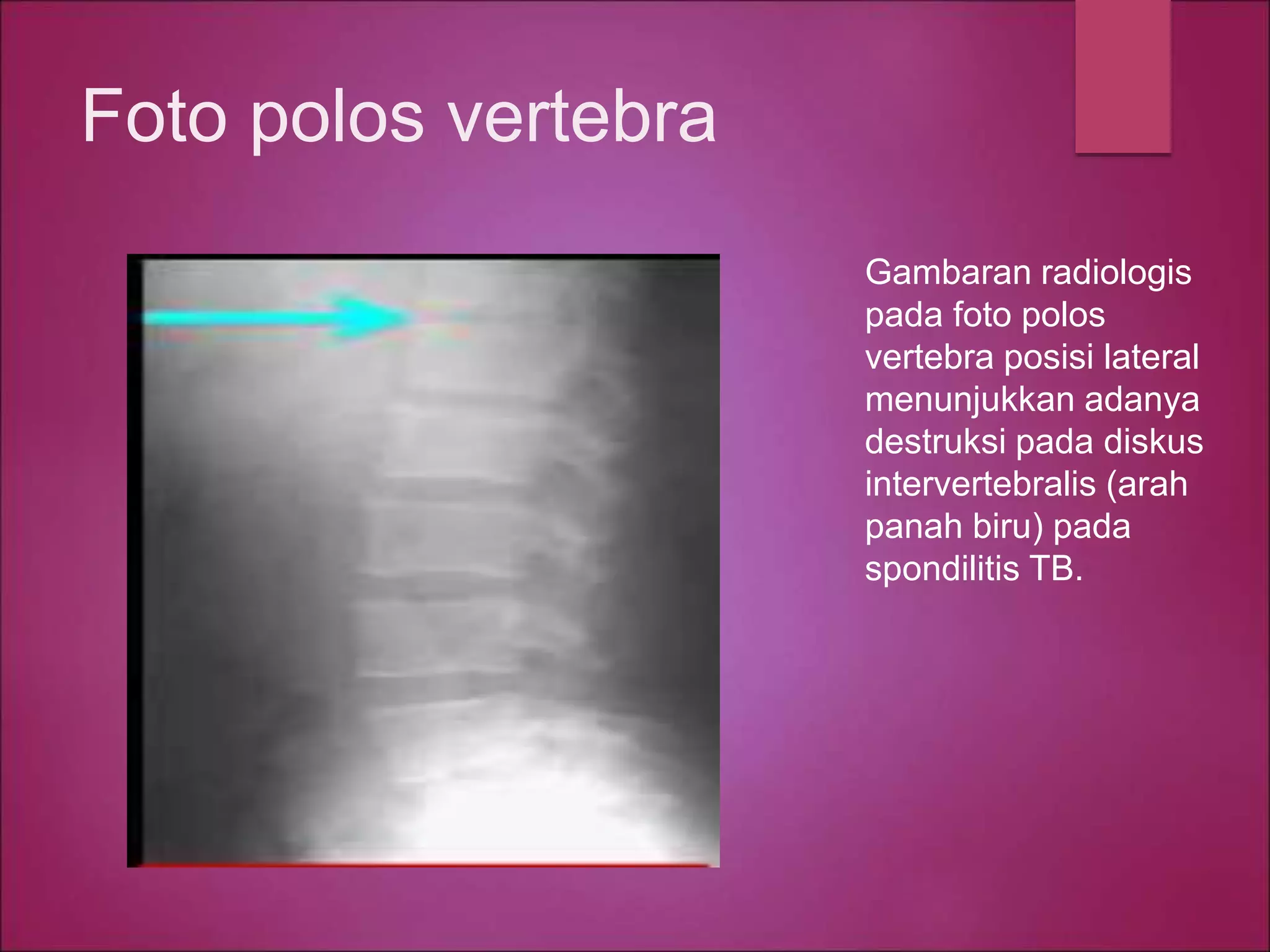 cupdf.com_slide-lapkas-spondilitis-tb.ppt