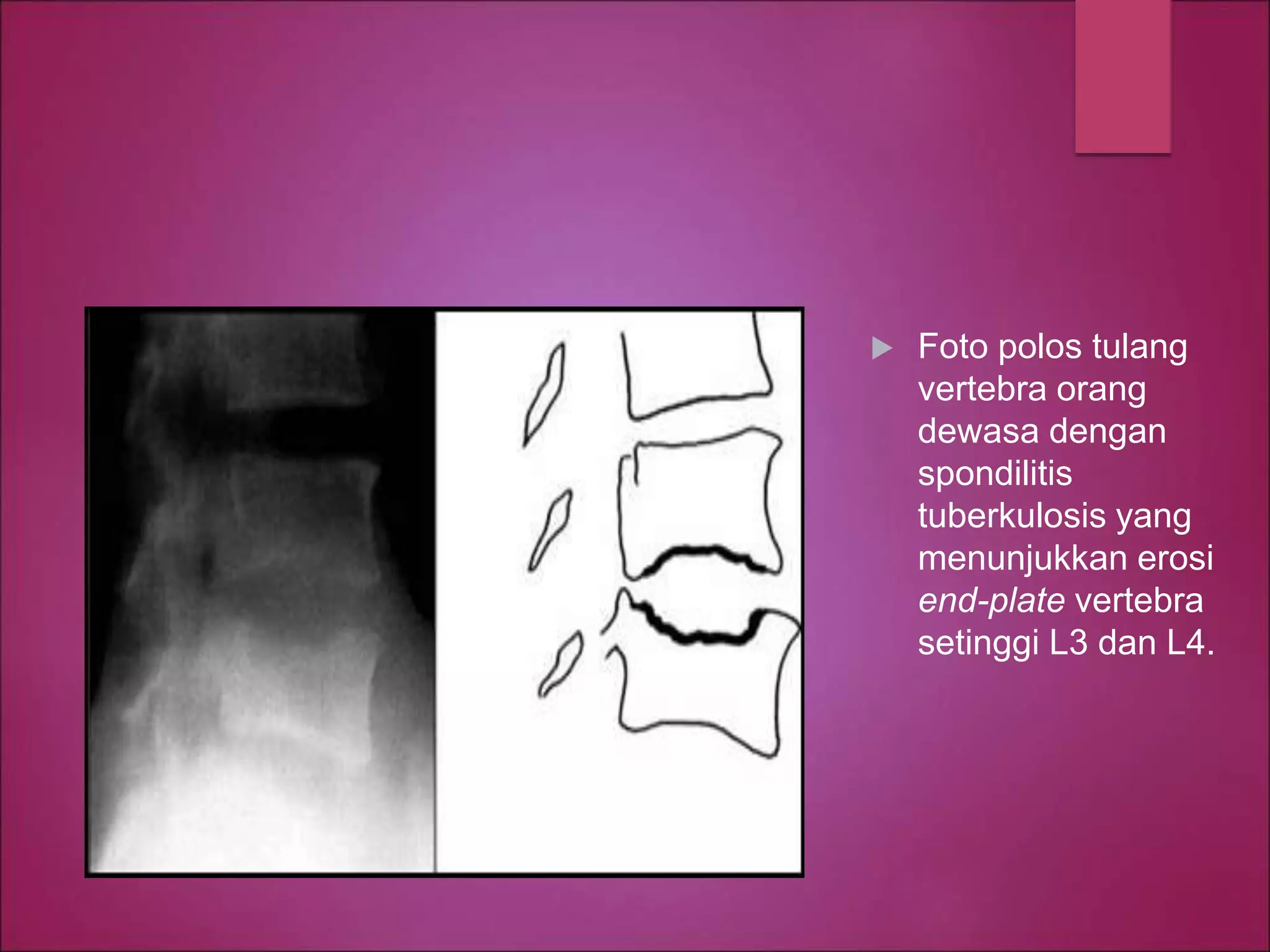 cupdf.com_slide-lapkas-spondilitis-tb.ppt