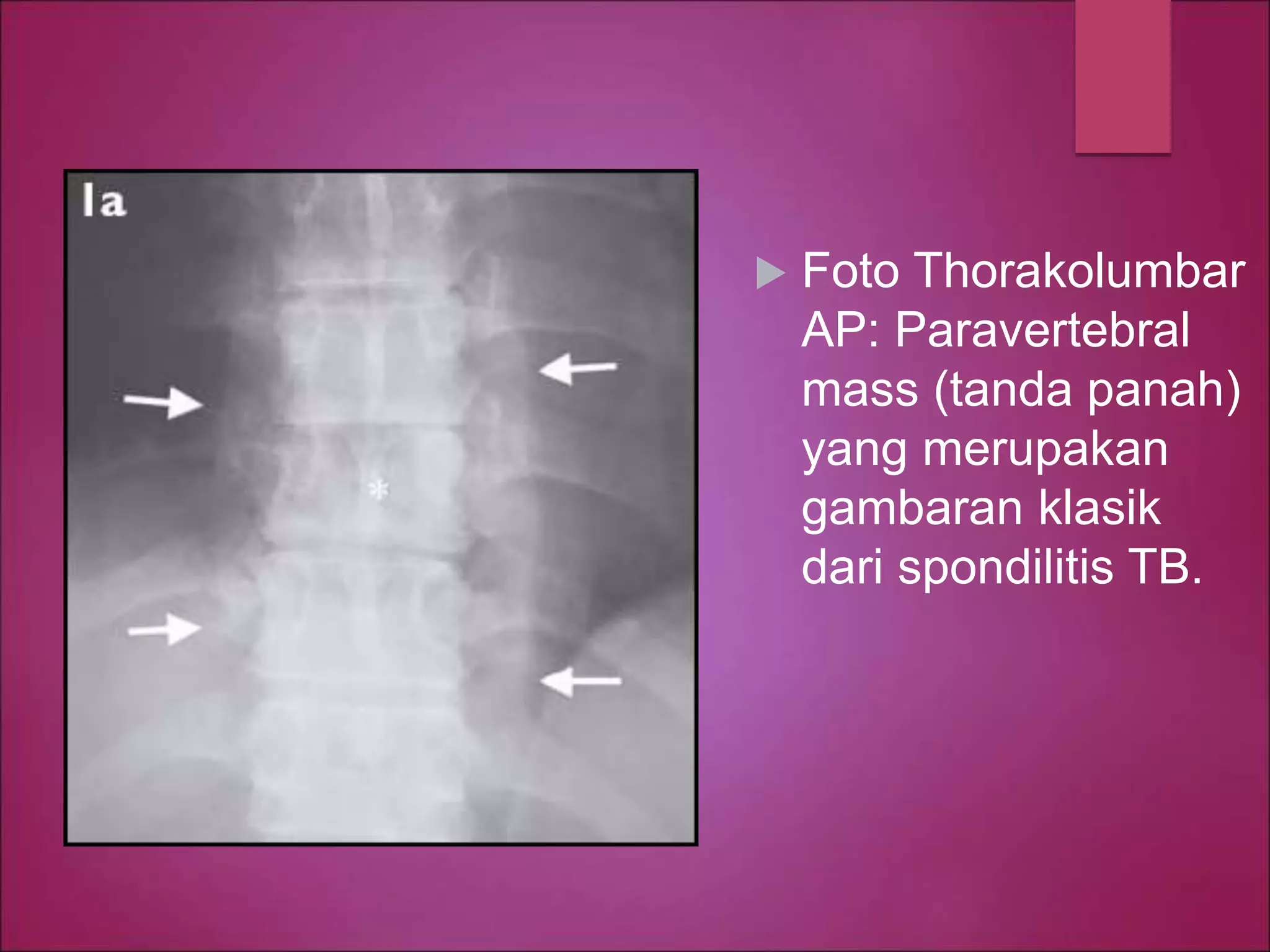 cupdf.com_slide-lapkas-spondilitis-tb.ppt