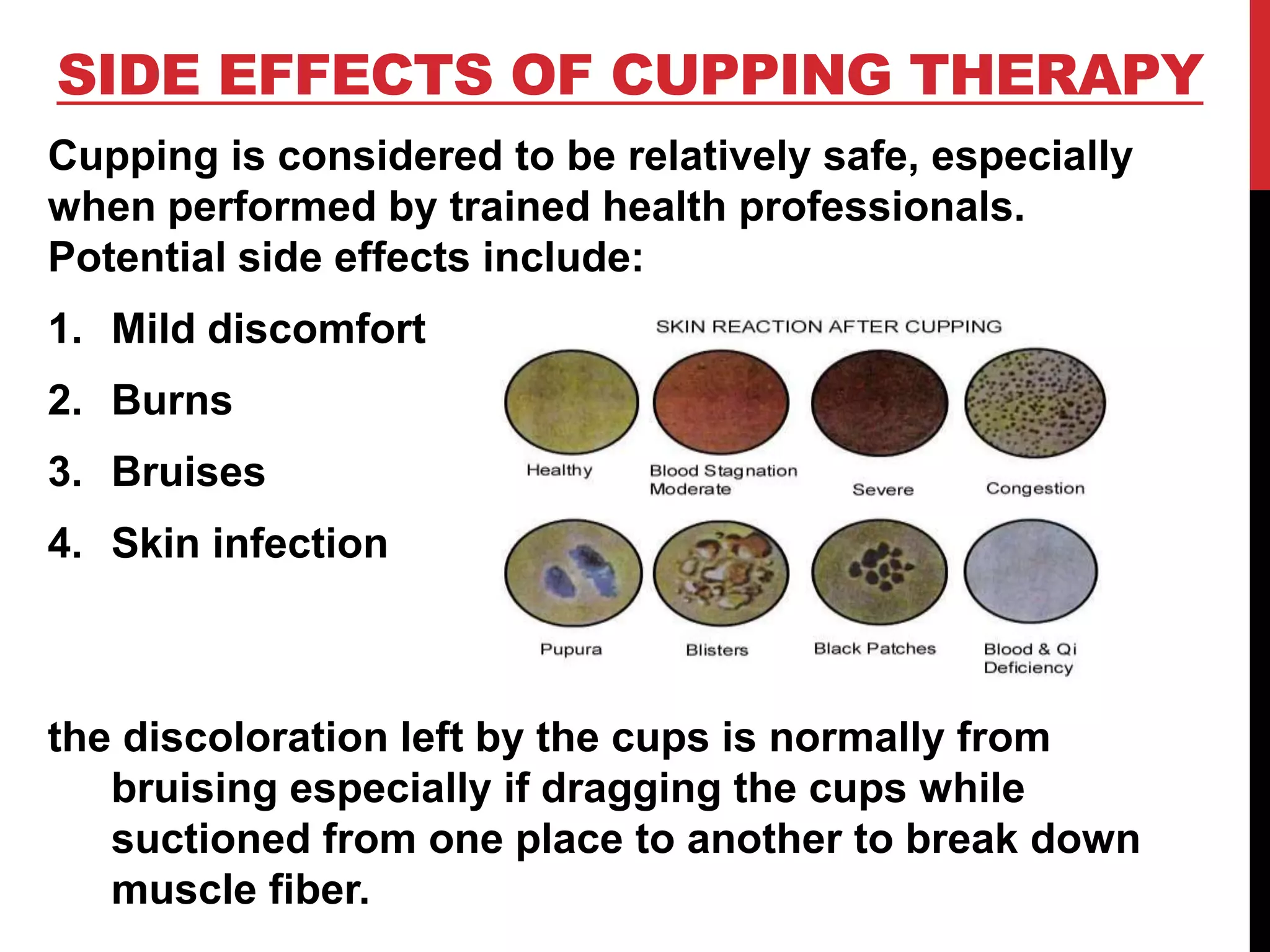 Cupping therapy | PPTX
