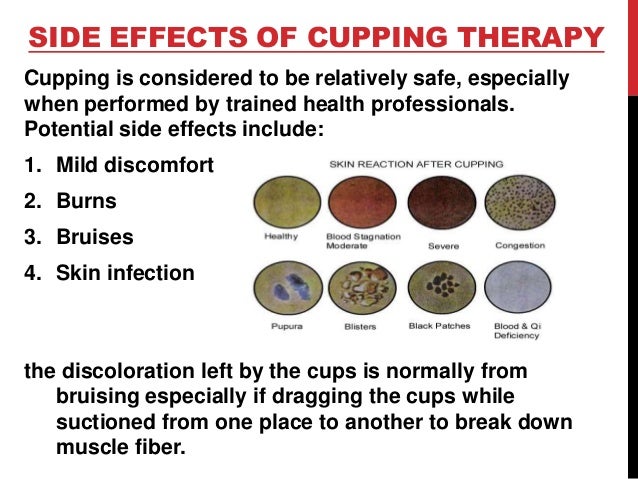 Cupping therapy