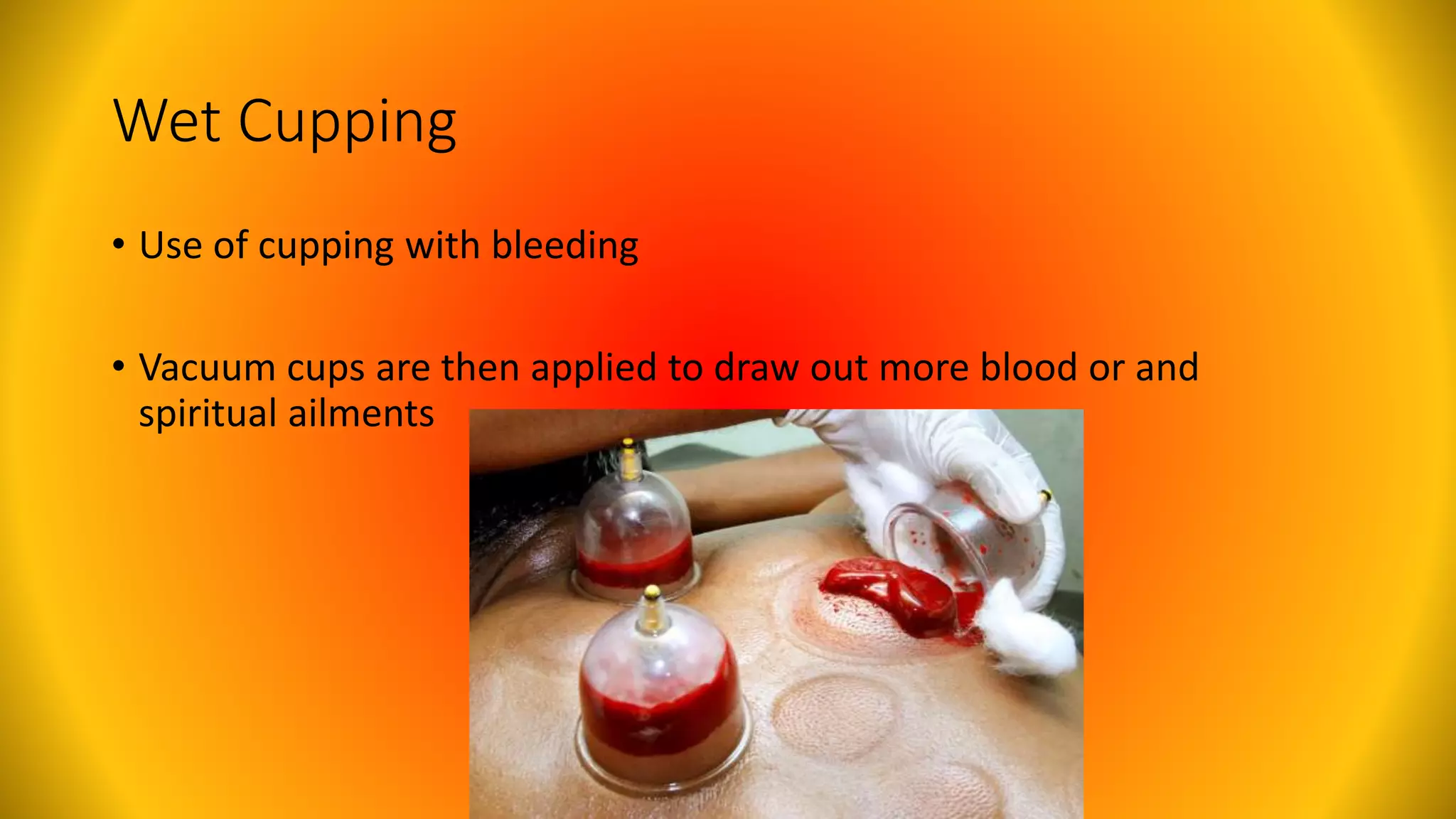 Cupping and bleeding dd | PPTX