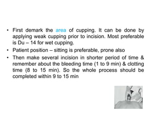 Wet Cupping | PPTX