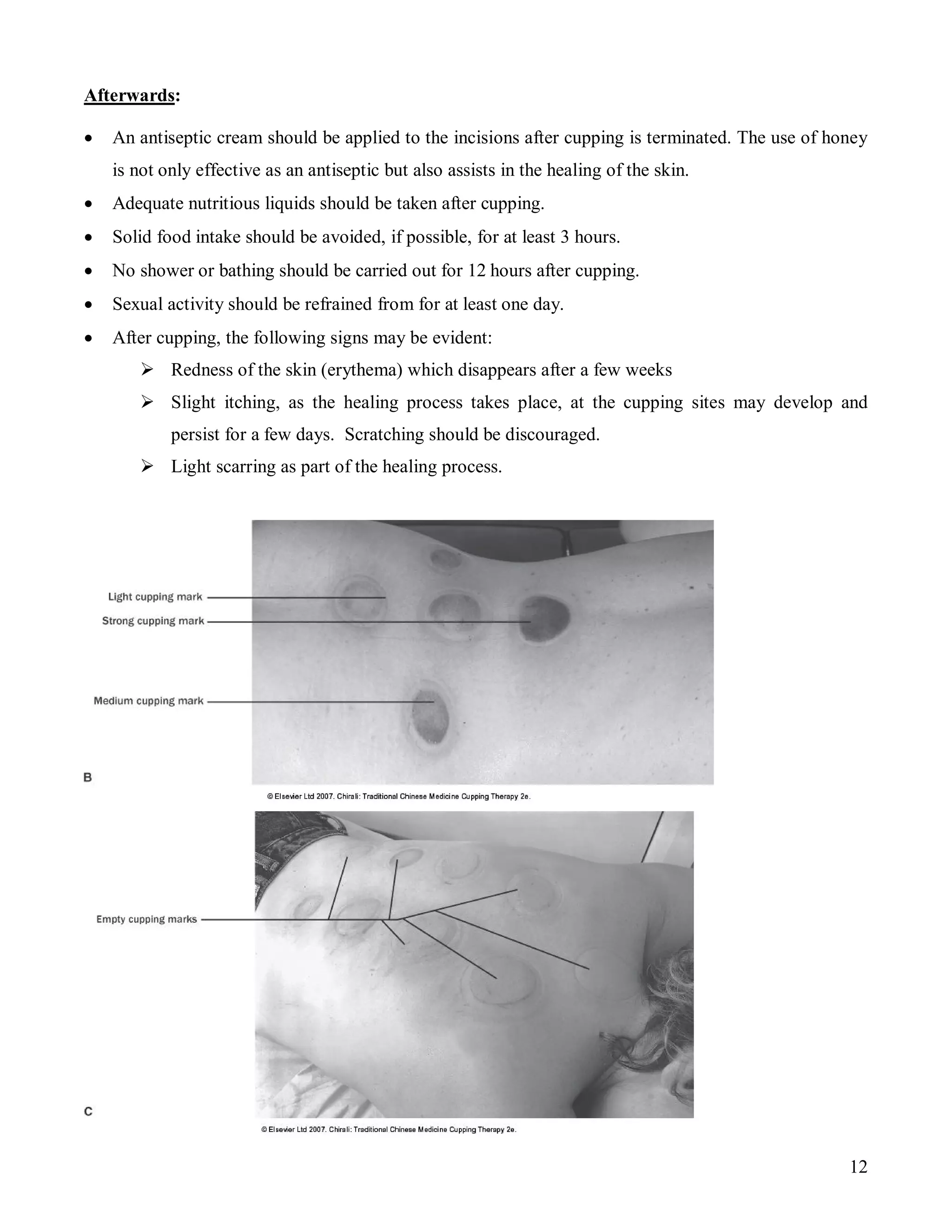 Cupping therapy | PDF