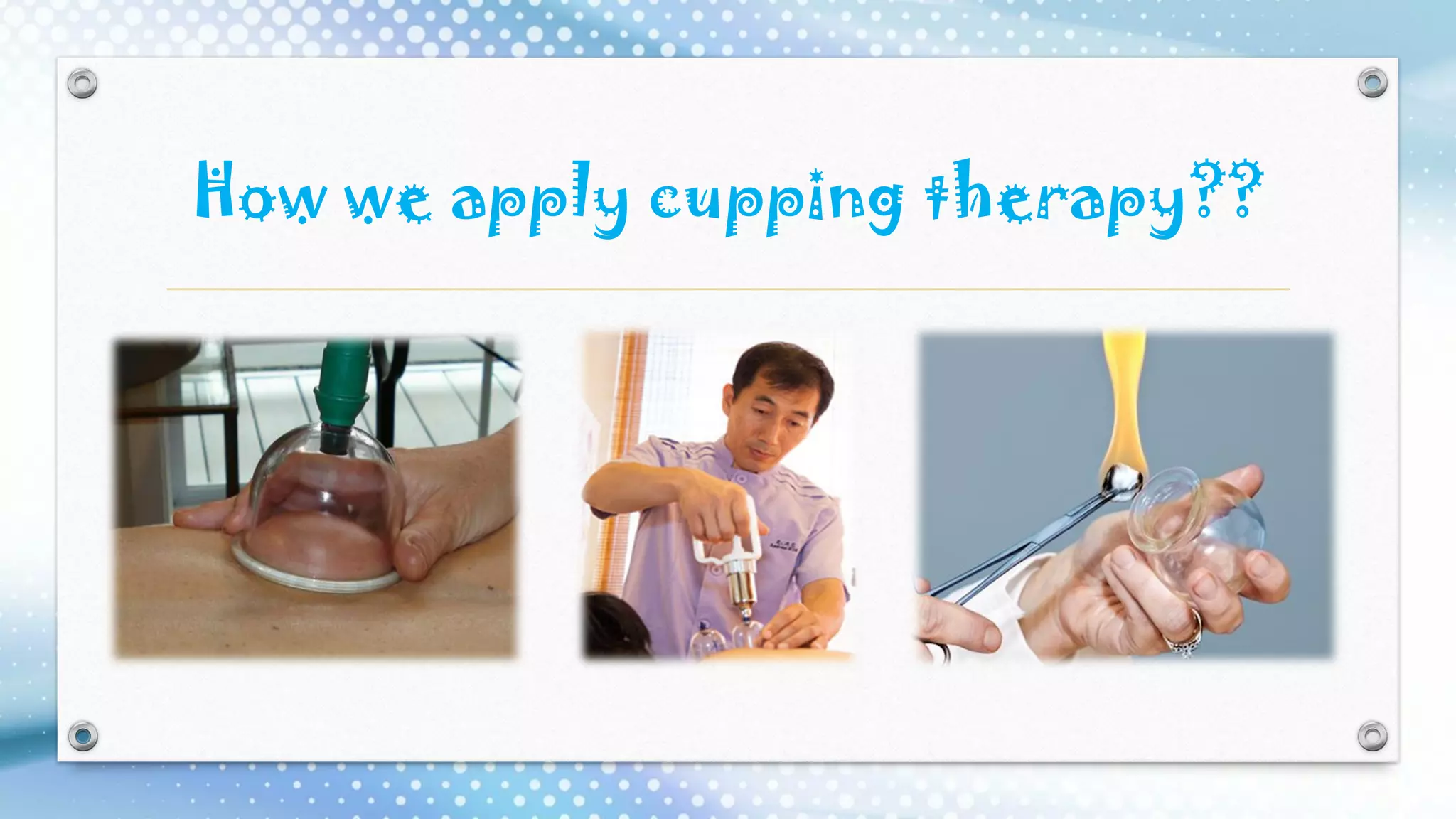 Cupping therapy 0000 | PDF