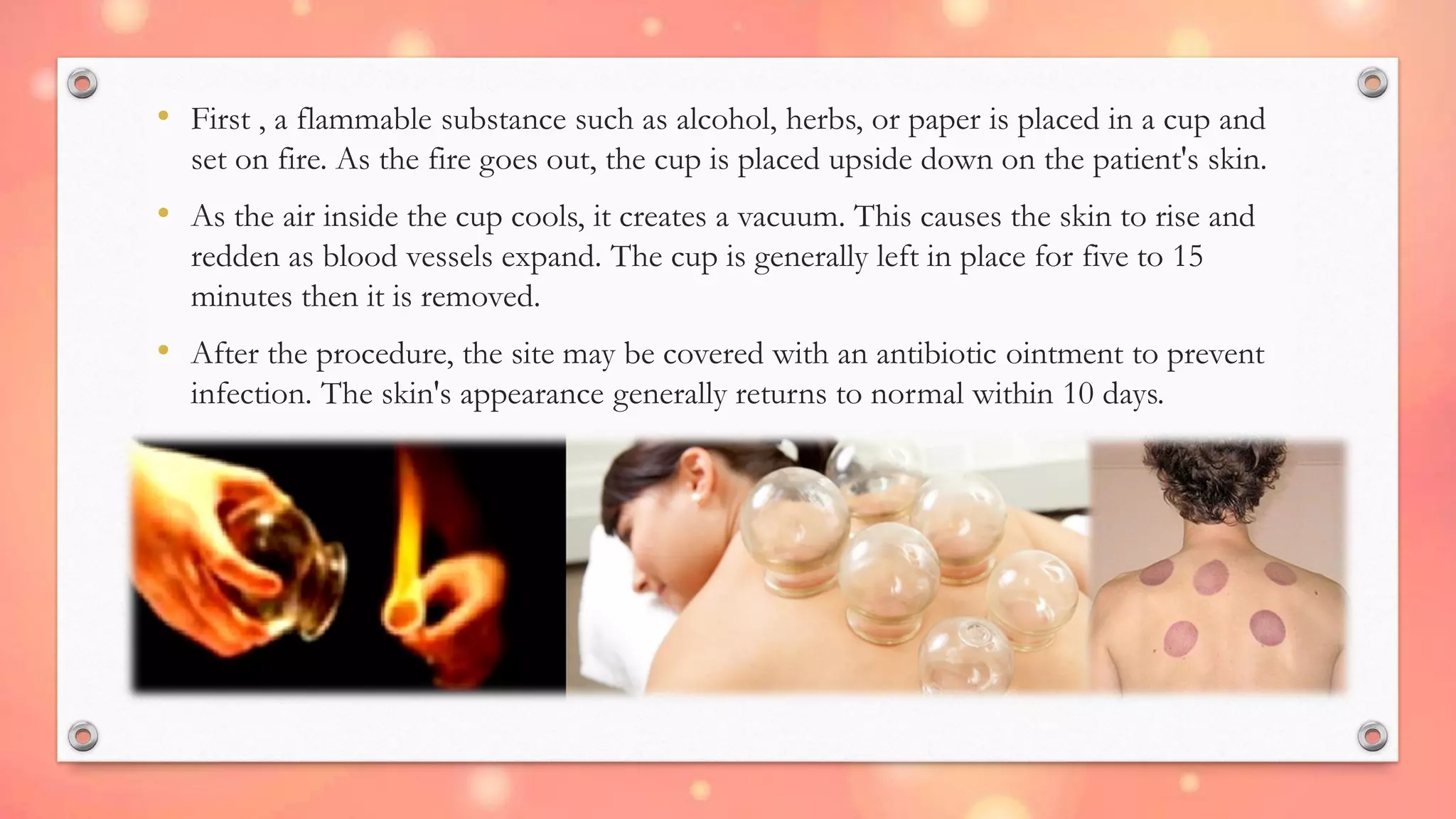 Cupping therapy 0000 | PDF