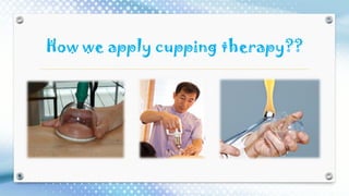 Cupping therapy 0000 | PDF