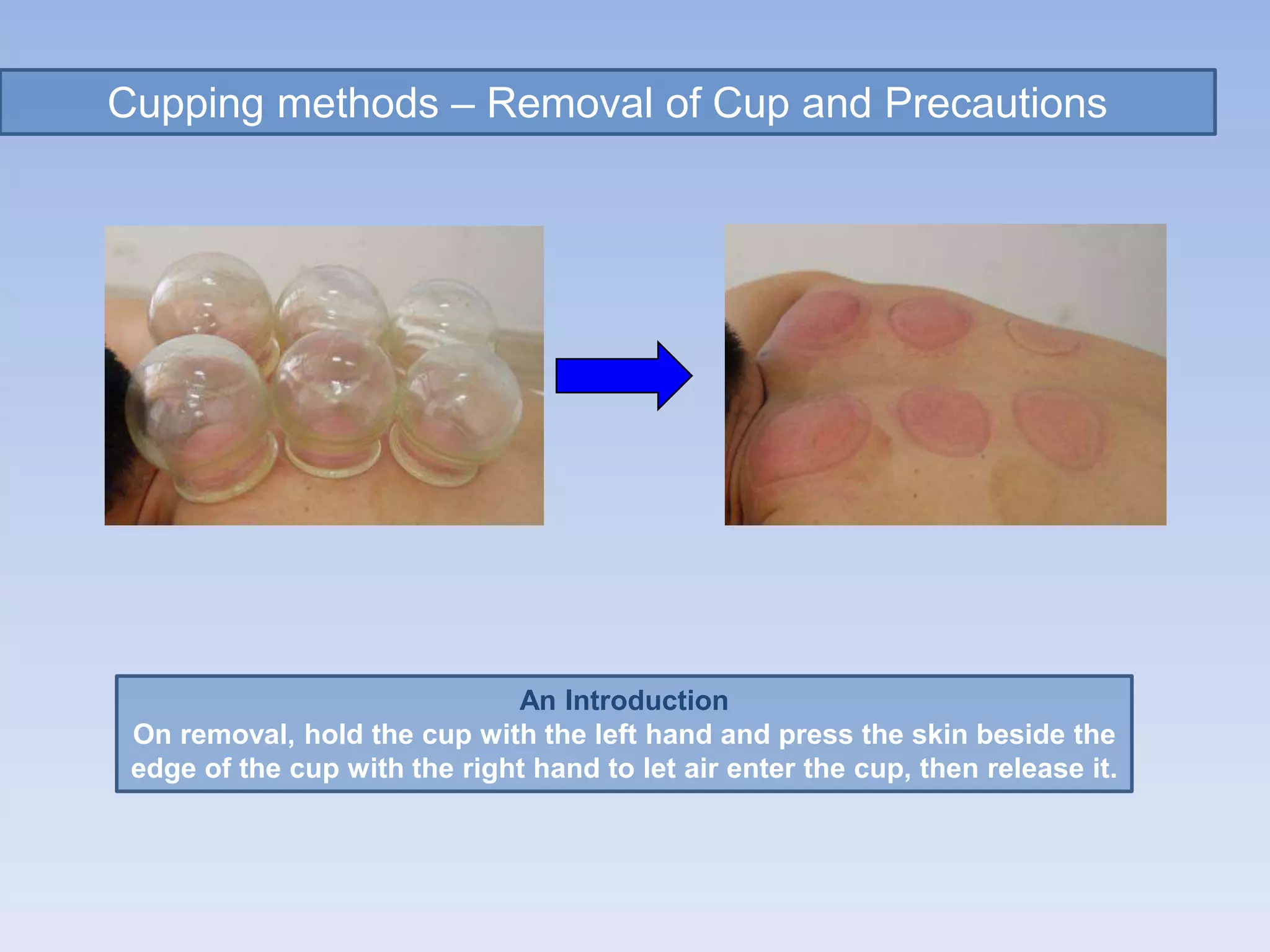 Learn about Cupping therapy | PPTX