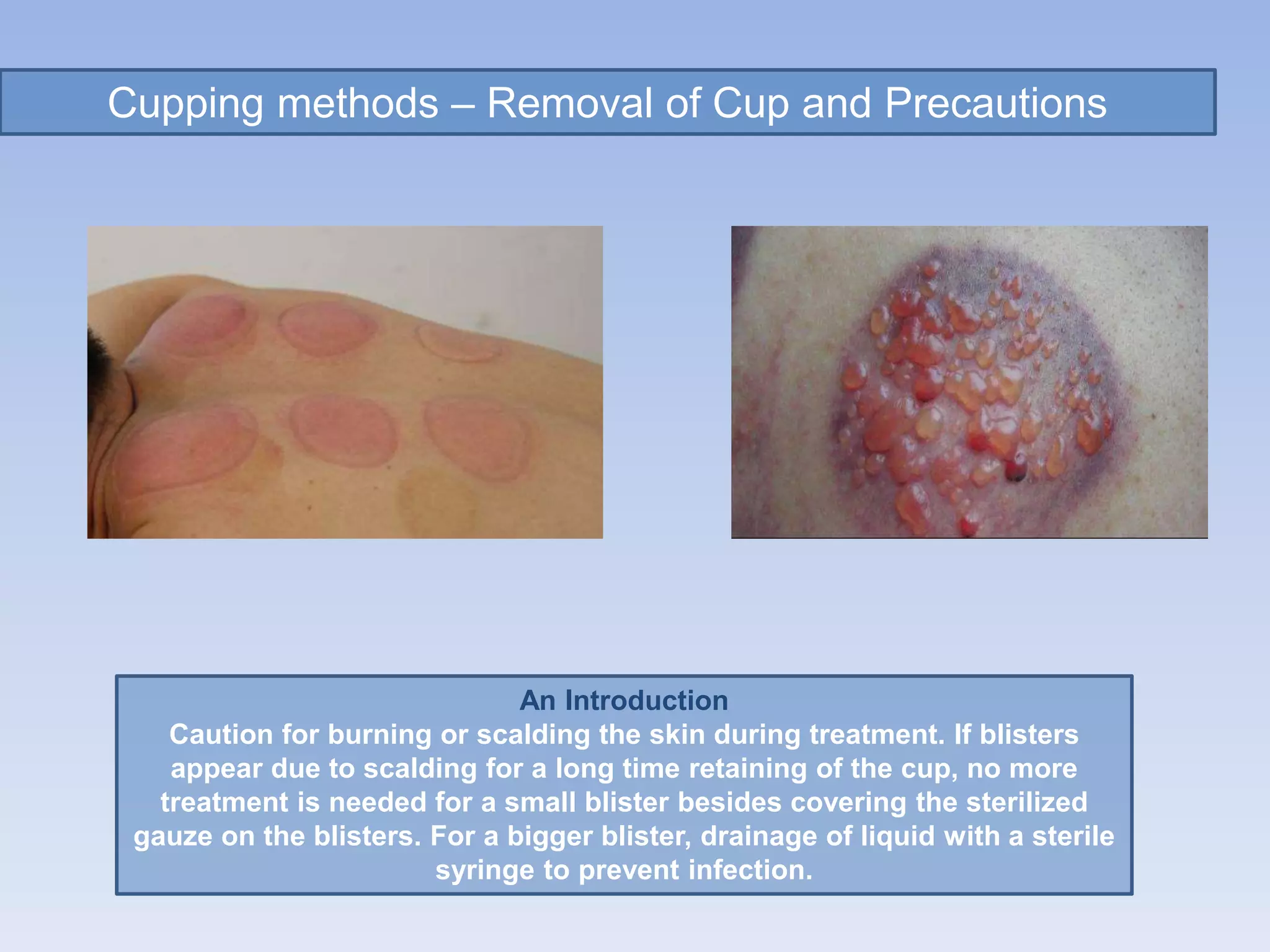 Learn about Cupping therapy | PPTX