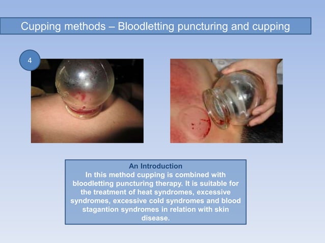 Learn about Cupping therapy | PPTX