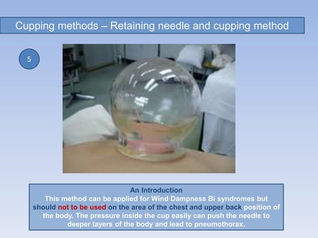 Learn about Cupping therapy | PPTX