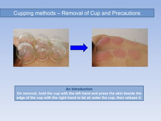 Learn about Cupping therapy | PPTX