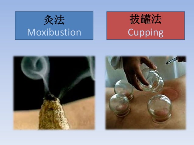 Learn about Cupping therapy | PPTX