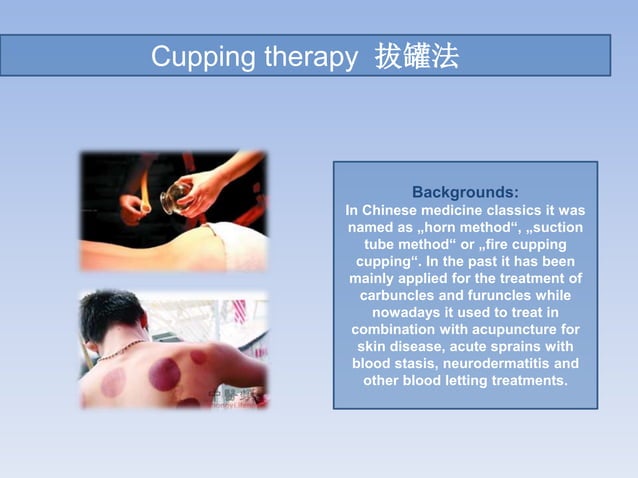 Learn about Cupping therapy | PPTX