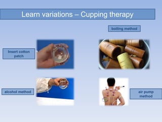 Learn about Cupping therapy | PPTX