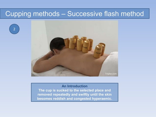 Learn about Cupping therapy | PPTX