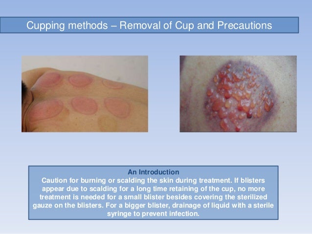 Learn about Cupping therapy