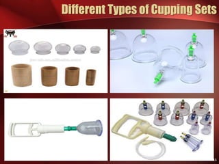 Cupping therapy | PPT