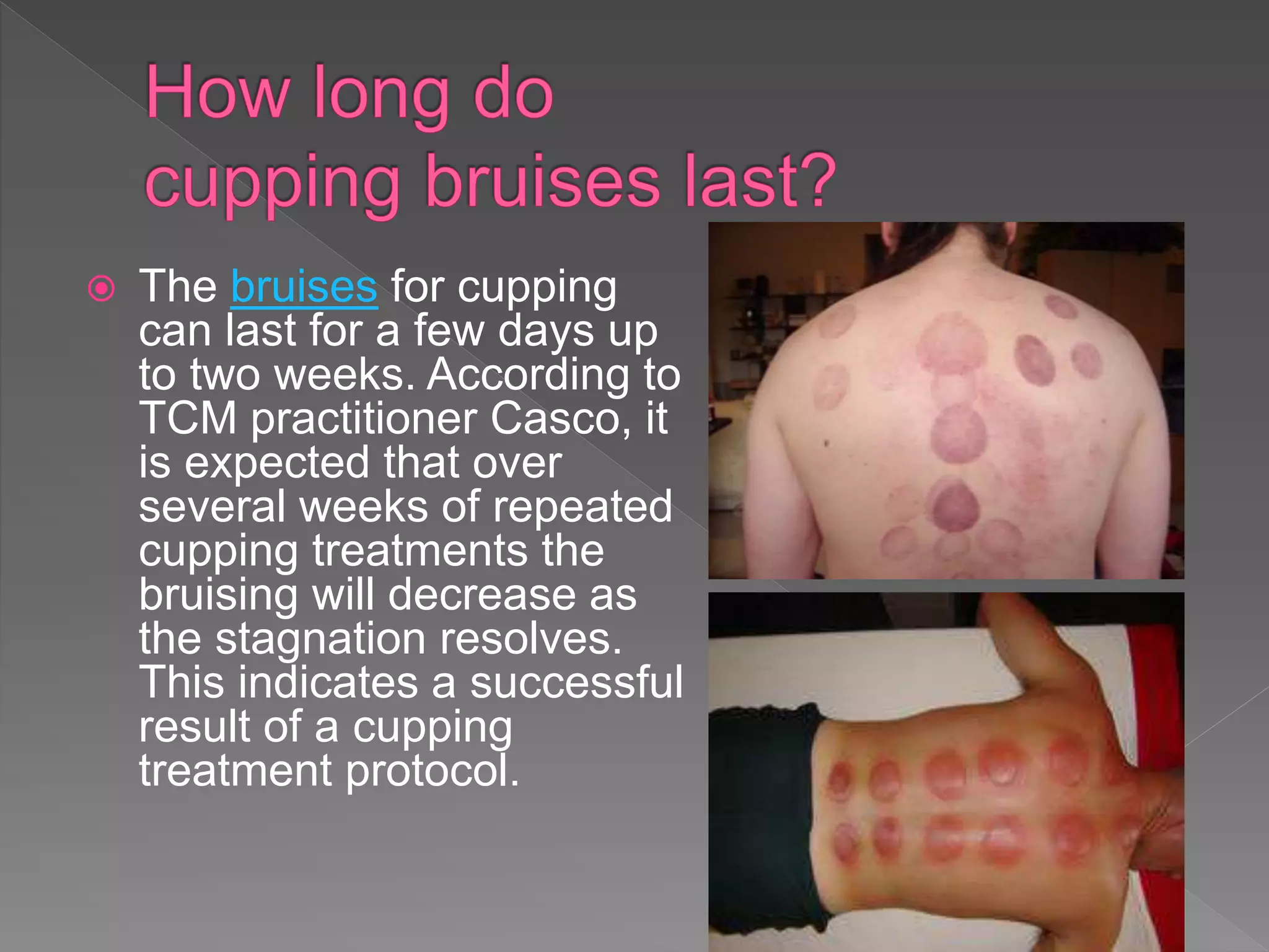 Cupping therapy | PPTX