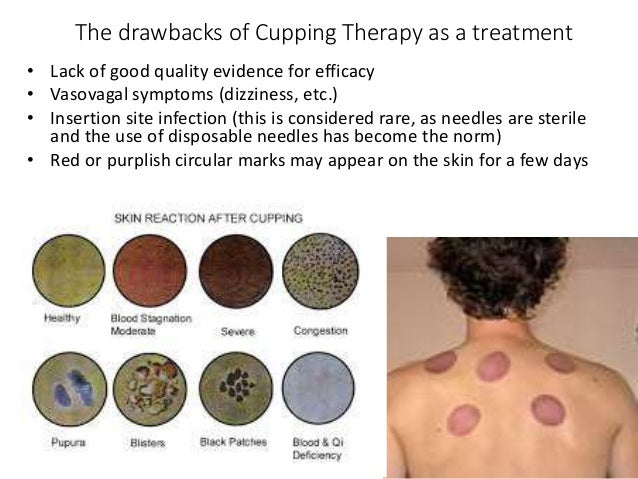 Cupping therapyforskindiseases