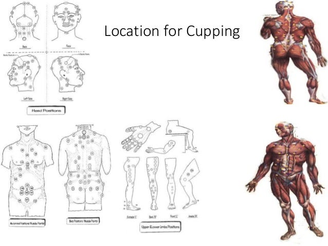 Cupping therapyforskindiseases