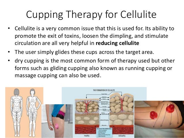 Cupping therapyforskindiseases