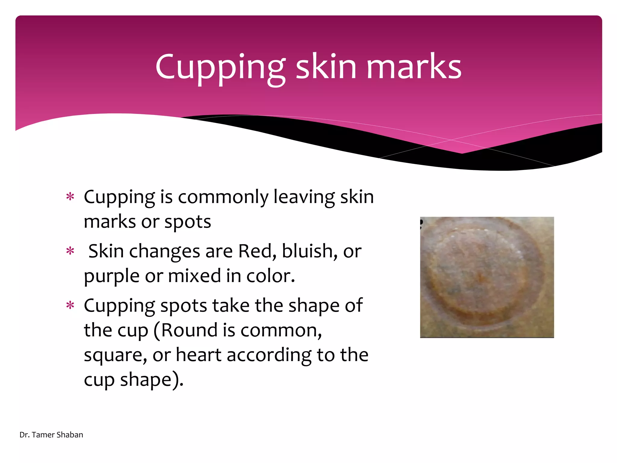 Skin Color Changes During Cupping Therapy : Explanations and ...