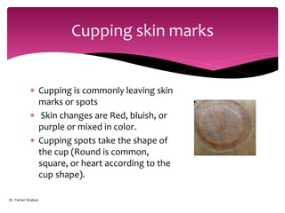 Skin Color Changes During Cupping Therapy : Explanations and ...