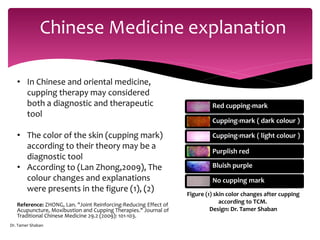 Skin Color Changes During Cupping Therapy : Explanations and ...