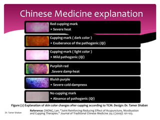 Skin Color Changes During Cupping Therapy : Explanations and ...