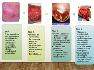 CURACIÓN DE HERIDAS: INTERVENCION DE ENFERMERIA.pdf