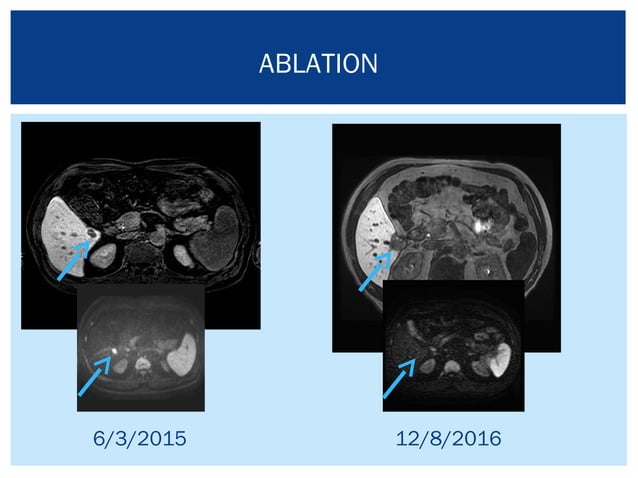 Liver Directed Therapy - Marlana Orloff, MD | PPT
