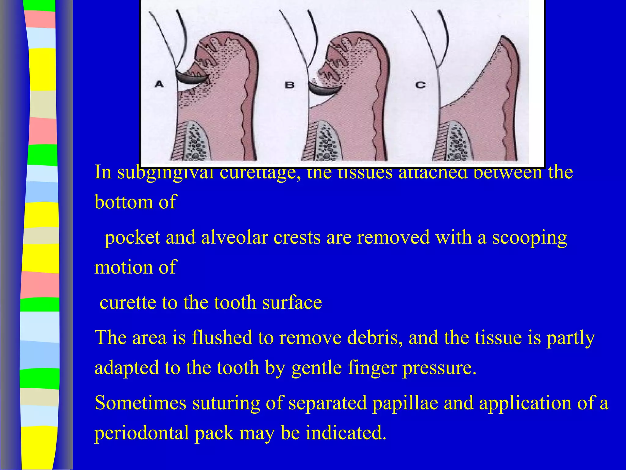 Curettage, gingivectomy & gingivoplasty | PPT