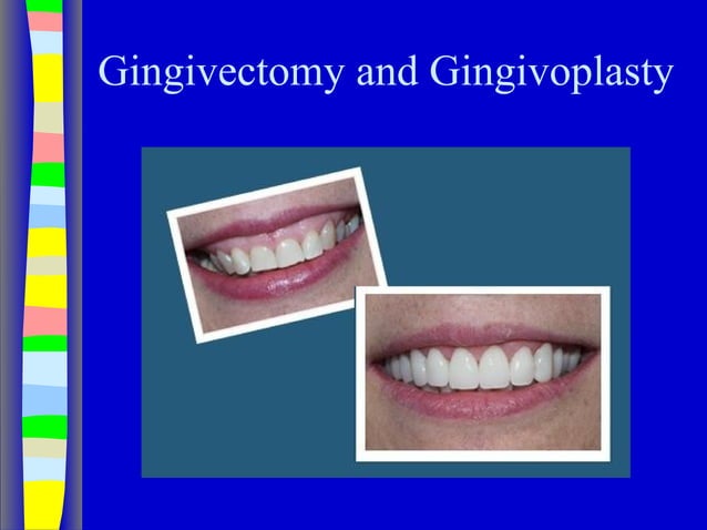 Curettage, gingivectomy & gingivoplasty | PPT | Oral care | Personal Care