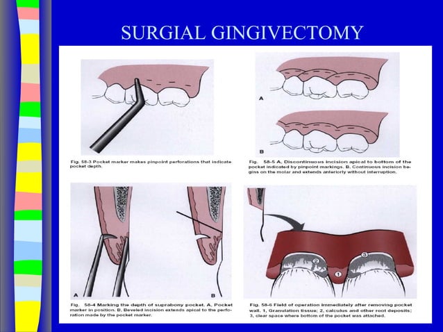 Curettage, gingivectomy & gingivoplasty | PPT | Oral care | Personal Care