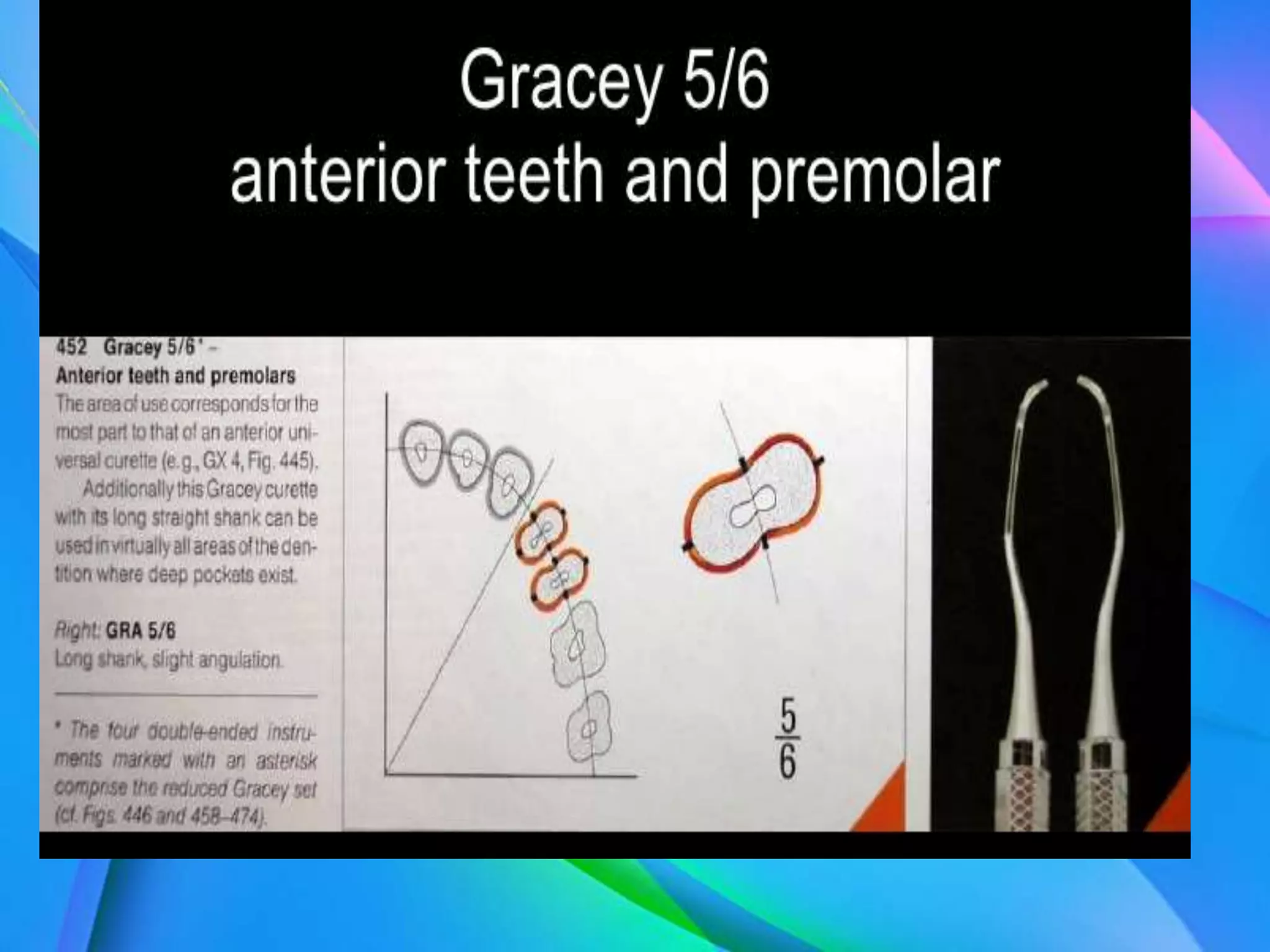Curettes | PPTX